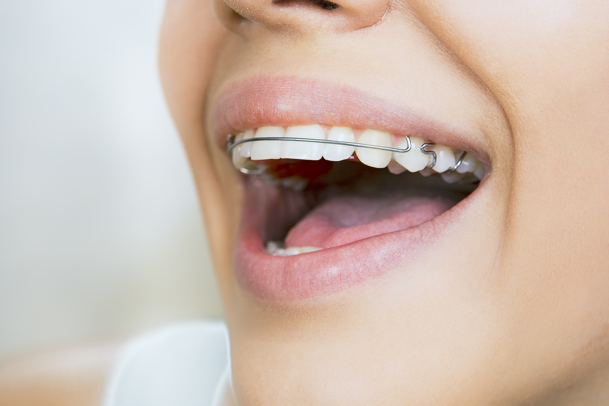 3 Habits to Practice Keeping Your Retainer in Your Mouth